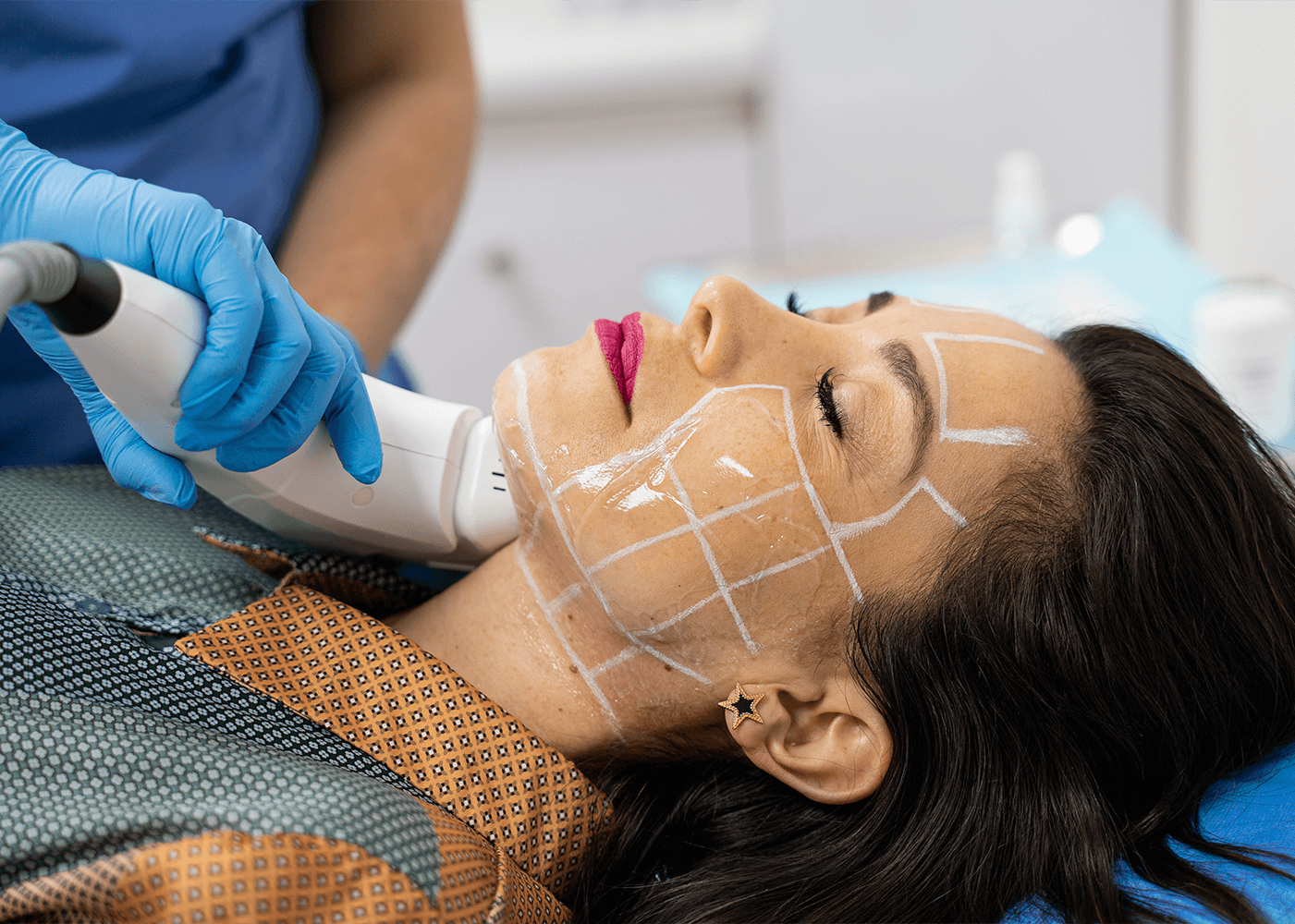 hifu 4d | Dermafemm Clinic®